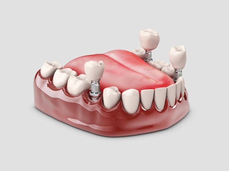 Multiple Teeth Replacement – Klas Klinik